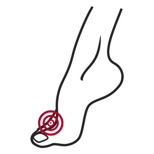 Overlapping Toes - Netstep